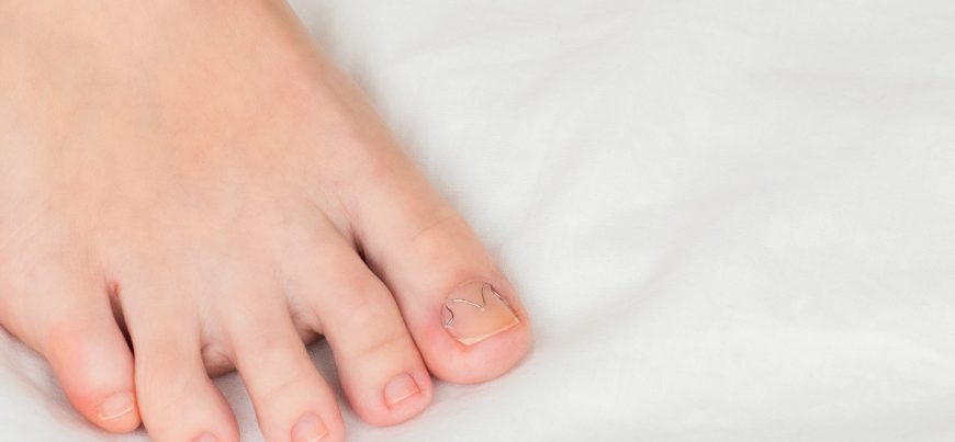 Ingrown Toenail Doctors | Best Diagnosis & Treatments | PFAC