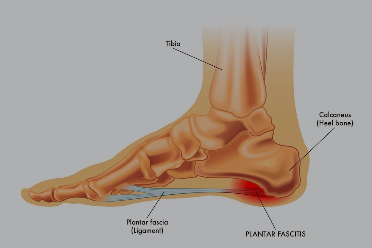 Plantar Fasciitis Treatment | Common Causes & Symptoms | PFAC