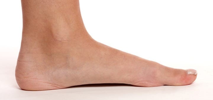 Flat Feet Specialists | Best Diagnosis & Treatments | PFAC