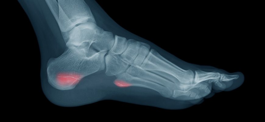 Foot Fractures Specialists | Best Diagnosis & Treatments | PFAC