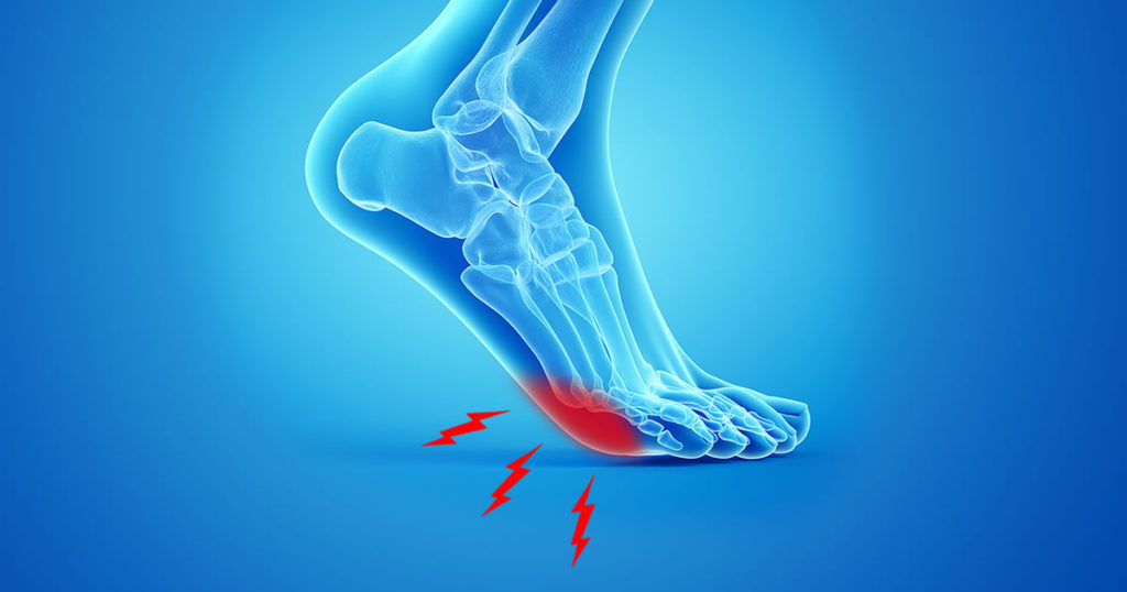 Neuromas Specialists | Morton's Neuromas Diagnosis & Treatment | PFAC